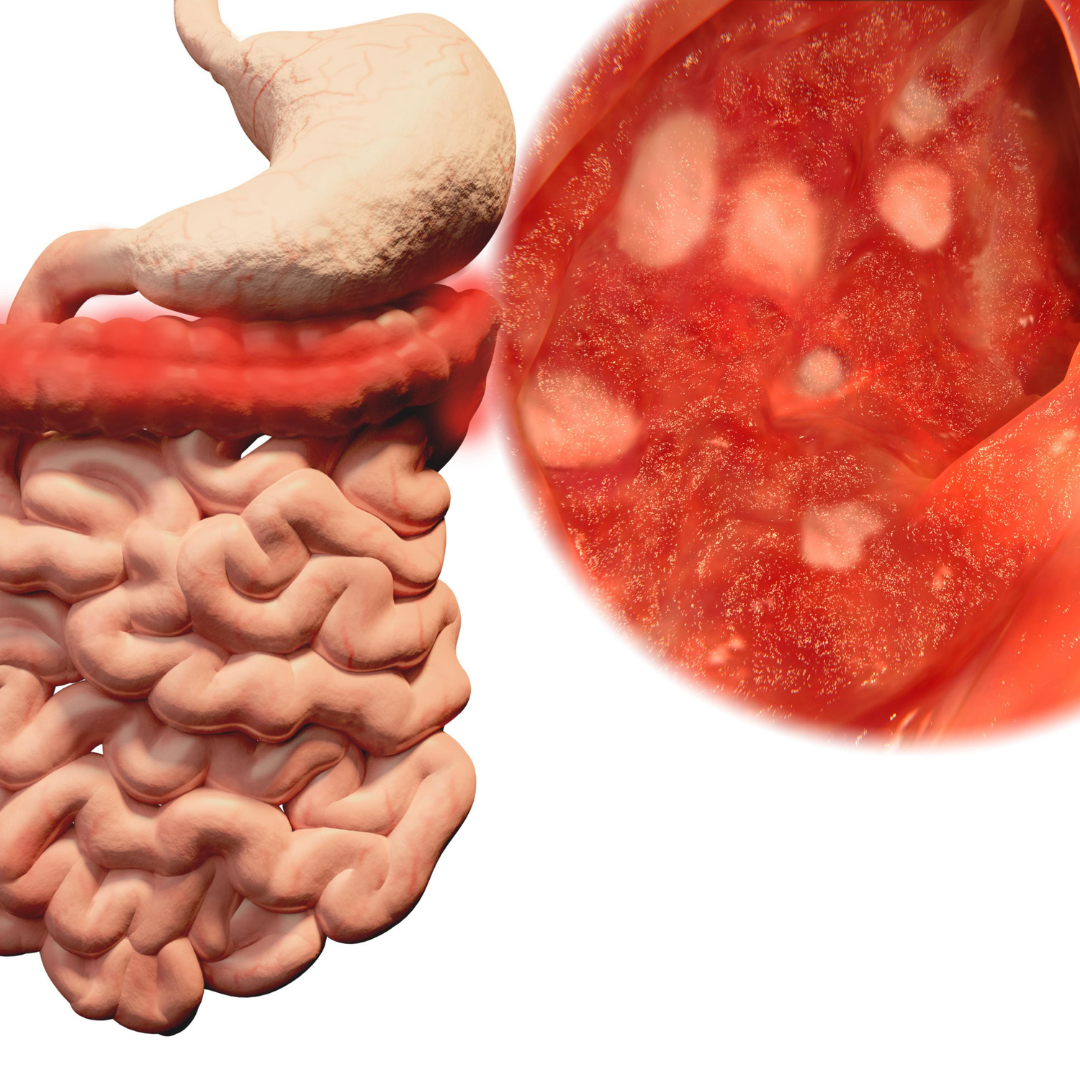 Colitis Ulcerosa – Voedingspiramide